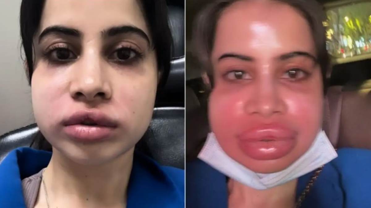 ചുണ്ട് വലുപ്പം കൂട്ടാന്‍ നോക്കി പണിപാളി | വീര്‍ത്ത് വികൃതമായ വിഡിയോ ...